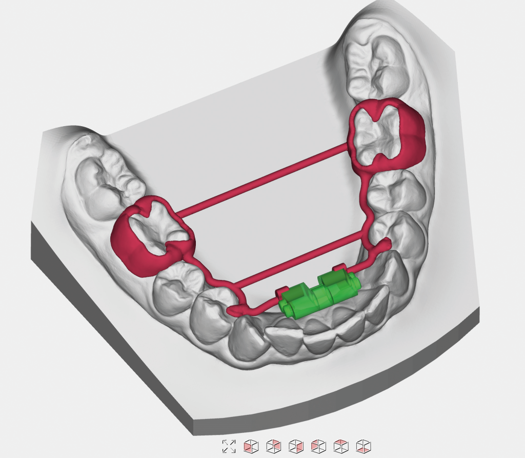 TORNILLO EXPANSOR PARA LA ARCADA INFERIOR CAD CAM TOOTH BORNE ...
