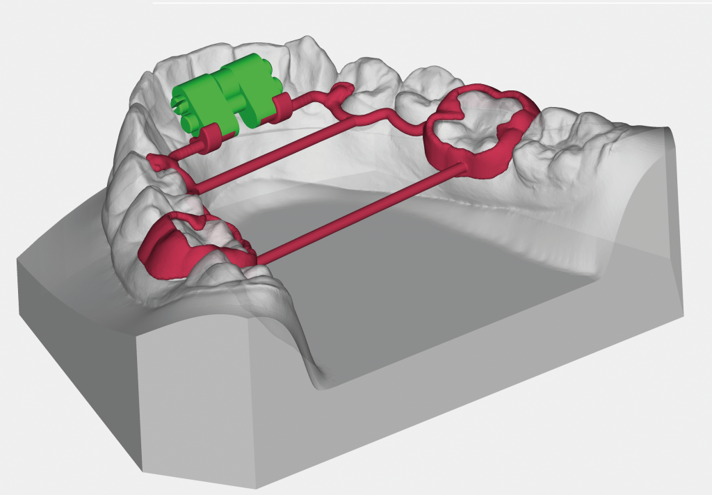 TORNILLO EXPANSOR PARA LA ARCADA INFERIOR CAD CAM TOOTH BORNE ...