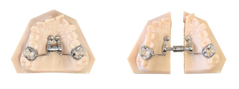 Telescopic CAD-CAM Expander: precisión digital para expansión maxilar